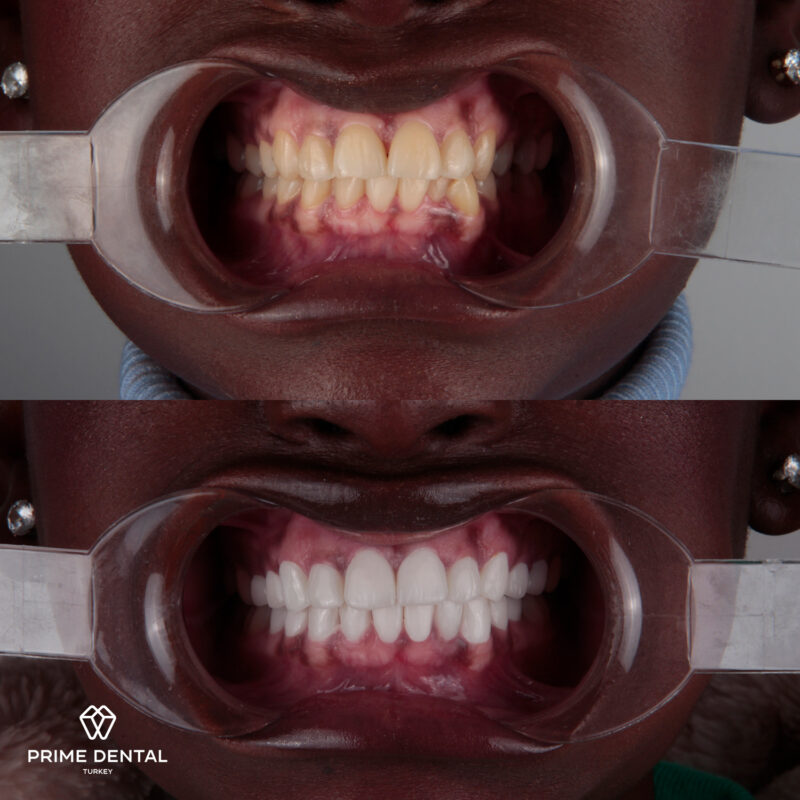 Dentures in Turkey - Prime Dental Turkey